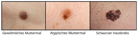 Wie Unterscheidet Sich Ein Leberfleck Von Hautkrebs