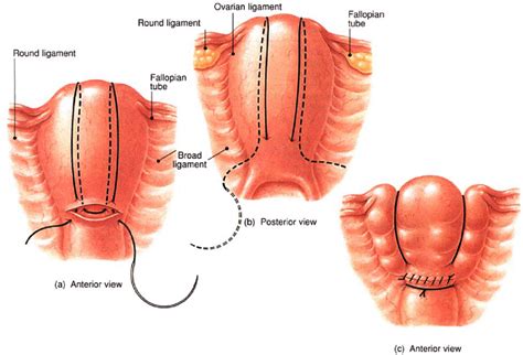 B Lynch Suture Full Article Catastrophic Uterine Rupture Associated