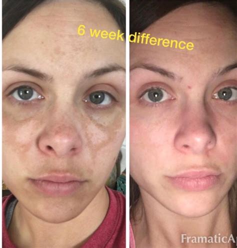 Makeup To Cover Melasma On Upper Lip Mugeek Vidalondon