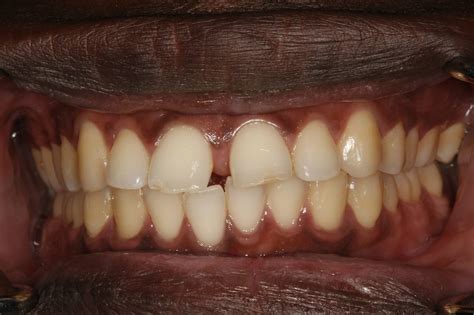 Spaces Between Teeth Diastema Diastemas Londons Leading Dentist Bioclear