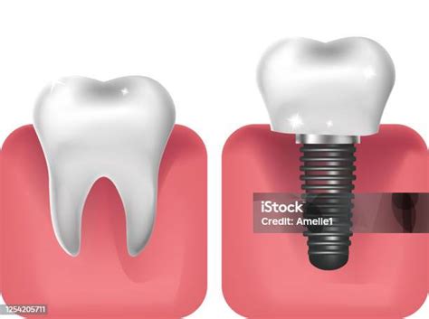 치과 임플란트 보철 3d 사실스타일 치과 건강한 치아 개념 벡터 일러스트레이션 벡터에 대한 스톡 벡터 아트 및 기타 이미지 벡터 보살핌 수평 구성 Istock