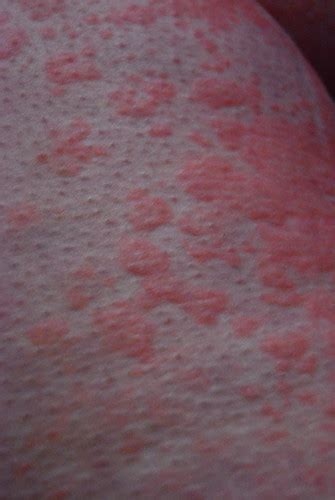 Relief For Hives Hives Causes