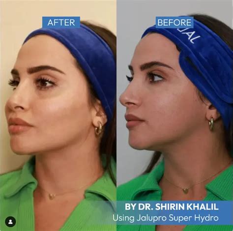 Jalupro Super Hydro About The Collagen Stimulator Medica Depot