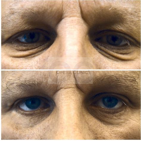 Operácia Očných Viečok Blepharoplastika Pred A Po Estheticonsk