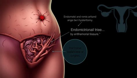 Understanding Can You Get Endometriosis After Hysterectomy