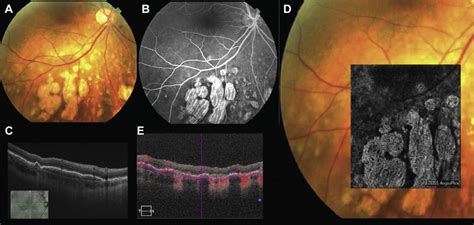 Lymphoma Choroidal Infiltration A Color Fundus Photography Shows