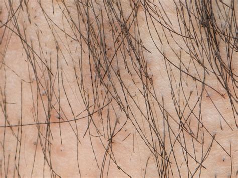 Beaded Hair Monilethrix At Milla Stelzer Blog