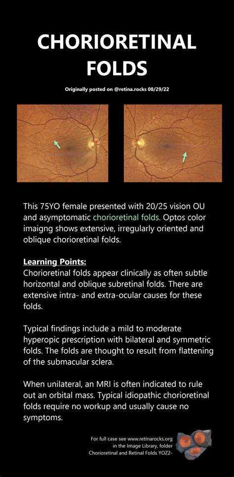 Disorders Causing Chorioretinal Folds Idiopathic Chorioretinal And