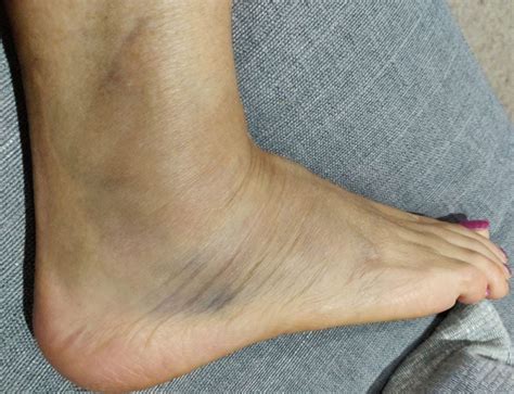 Sprained Ankle Vs Rolled Ankle Understanding The Differences