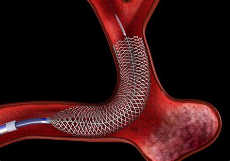 Flow Diverter In Aneurysm Cgtrader