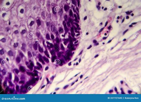 Cancer Of Cervix Light Micrograph Of Cervical Biopsy Photo Under