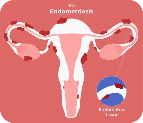 Uncommon Symptoms Of Endometriosis Hidden Clues Inito