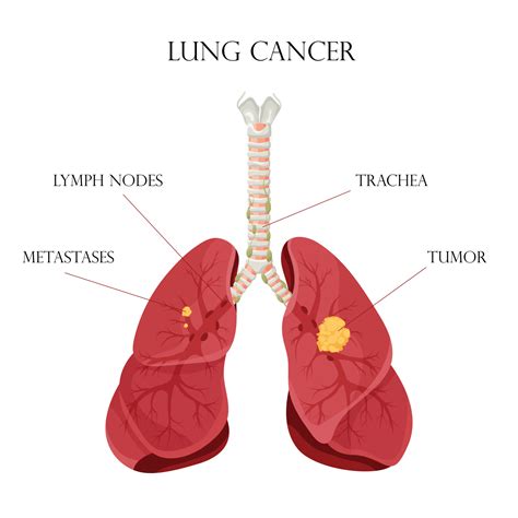 Diagramme De La Maladie Du Cancer Du Poumon Concept Maladie Organes