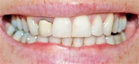 Compliance Compliance Compliance Why Invisalign Compliance Is Key