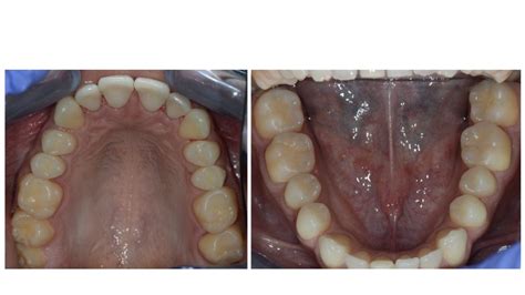 Injectable Composites Quick Fix Or Long Lasting Solution Dentistry