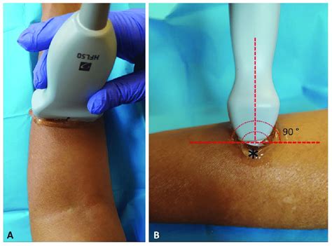 The Probe Position During The Ultrasound Us Imaging Assessment Of The Download Scientific