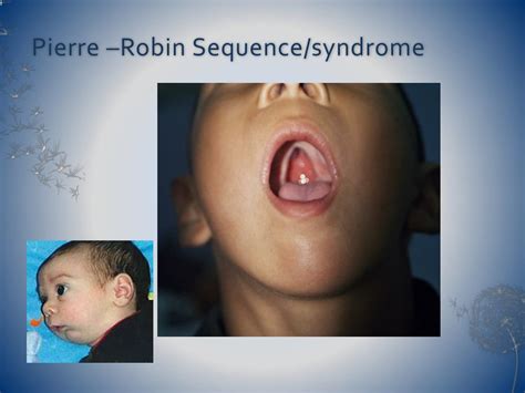 Ppt Craniofacial Disorders Powerpoint Presentation Free Download