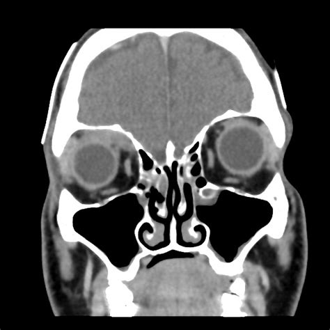 Idiopathic Orbital Inflammatory Disease Pacs