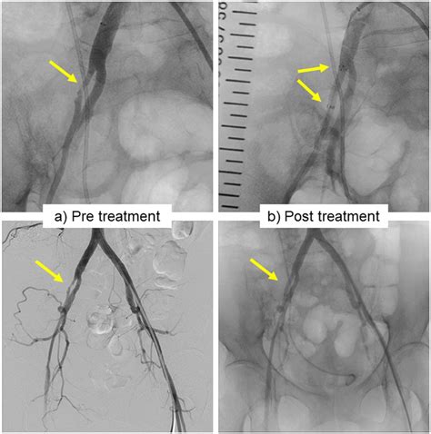 Pretreatment Angiography Showed Narrowing Of The External Iliac Artery