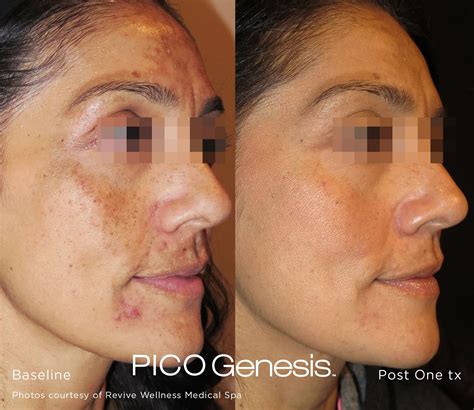 ENLIGHTEN PICO GENESIS CosMediSpa