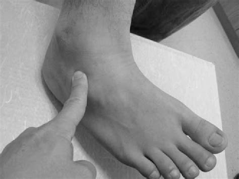 Inferior Extensor Retinaculum Semantic Scholar