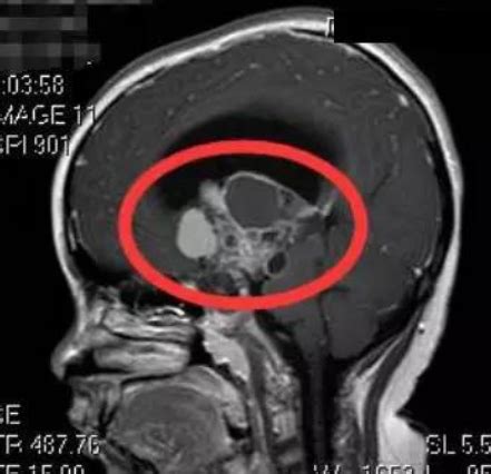 颅咽管瘤全切复发概率是多少？ Inc国际神经外科医生集团