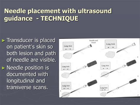 Ppt Minimally Invasive Breast Procedures Powerpoint Presentation Id
