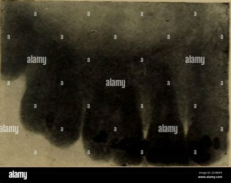Insomnia And Nerve Strain Case 15—acutemania Impac Ted Cuspid