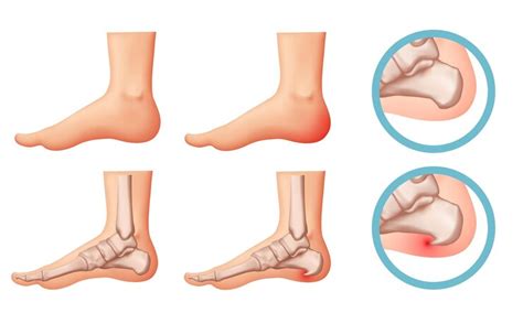Premium Vector Heel Spur Illustration Design Elements On The Theme Of