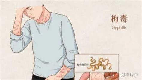 请问我这是梅毒硬下疳初期吗 知乎