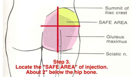 How To Perform Intramuscular Im Injections Testosterone B12 Bcaa