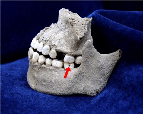 Dental Caries Seen On Buccal Surface Of Mandibular Second Molar Download Scientific Diagram