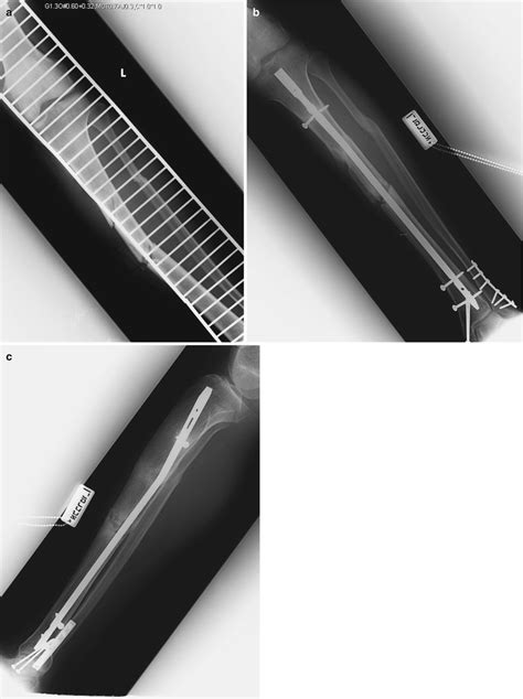Tibia Diaphysis Musculoskeletal Key
