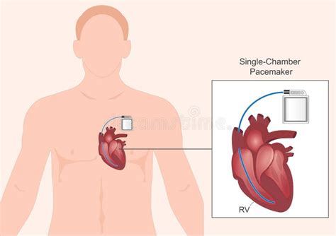 Single Chamber Pacemakertype Of Pacemaker Stock Illustration
