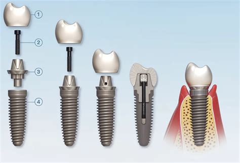 Understanding Dental Implant Parts A Complete Guide Aesthetic Airways