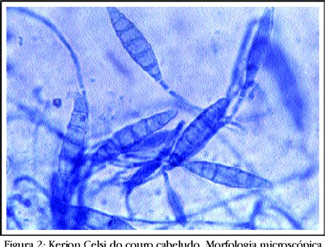 Figure 1 From Kerion Celsi Por Microsporum Gypseum Celsus Kerion Caused By Microsporum Gypseum