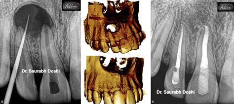 Non Surgical Management Of Large Apical Lesion With Open Apex Style