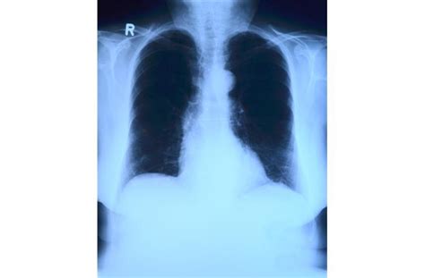 Innovations In Dental X Ray Imaging Performance Testing Equipment Flammability Testing