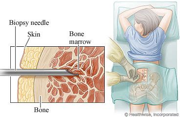 Bone Marrow Aspiration And Biopsy Nurses Zone Source Of Resources