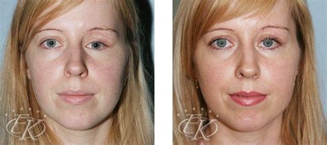 Блефаропластика верхних век Пластический хирург Кудинова