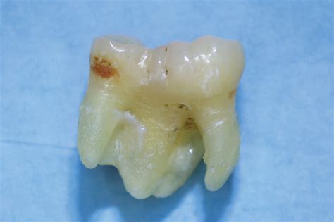 Buccal View Of The Geminated Tooth Of 48 Download Scientific Diagram