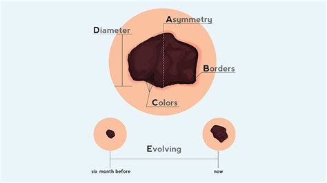 Melanoma Or Liver Spots How To Tell The Difference