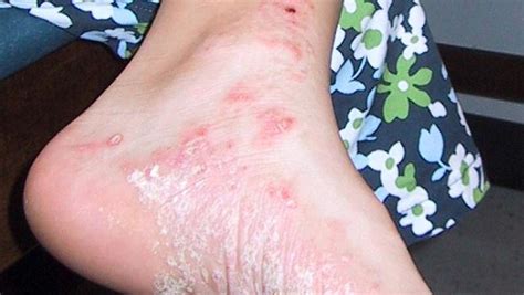 Modest Efficacy For Methotrexate In Psoriasis Rheumnow