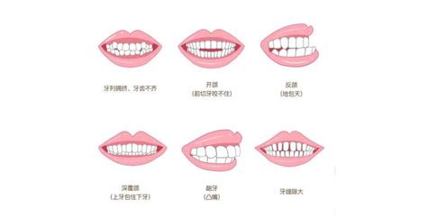 正畸面诊要问的问题！建议收藏 知乎