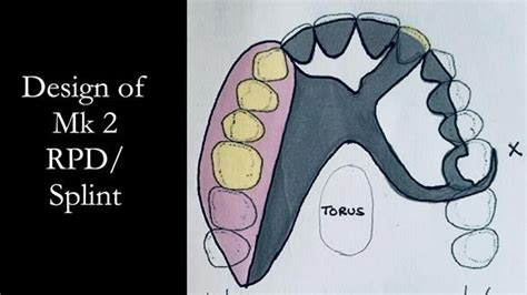 newsletter 51 managing anne s failing dentition with distal extension