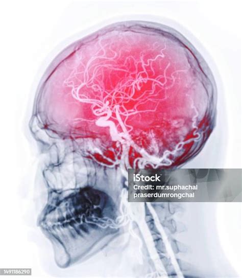 Cta Otak Atau Ct Angiografi Otak 3d Rendering Fusi Gambar Dengan