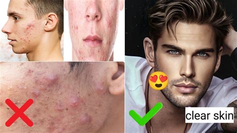 Pimples Remova At Home🤫 In 7 Dayspimple Ko Hatane Ka Tarika Youtube
