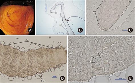 An Unexpected Encounter During A Screening Colonoscopy In A Medical