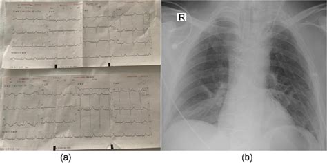 A Electrocardiogram B Postoperative Chest X Ray Download