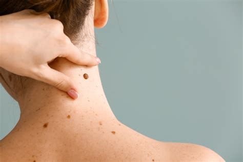 Self Skin Cancer Exams And Prevention Tips Us Dermatology Partners